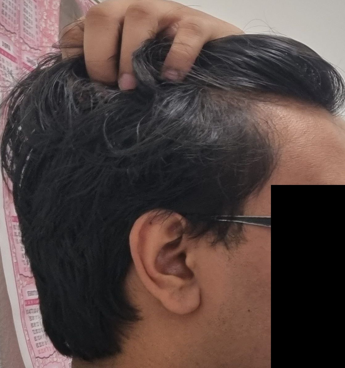 Used Finasteride for almost 8 years (Results + Pics) + Future Plan : r ...